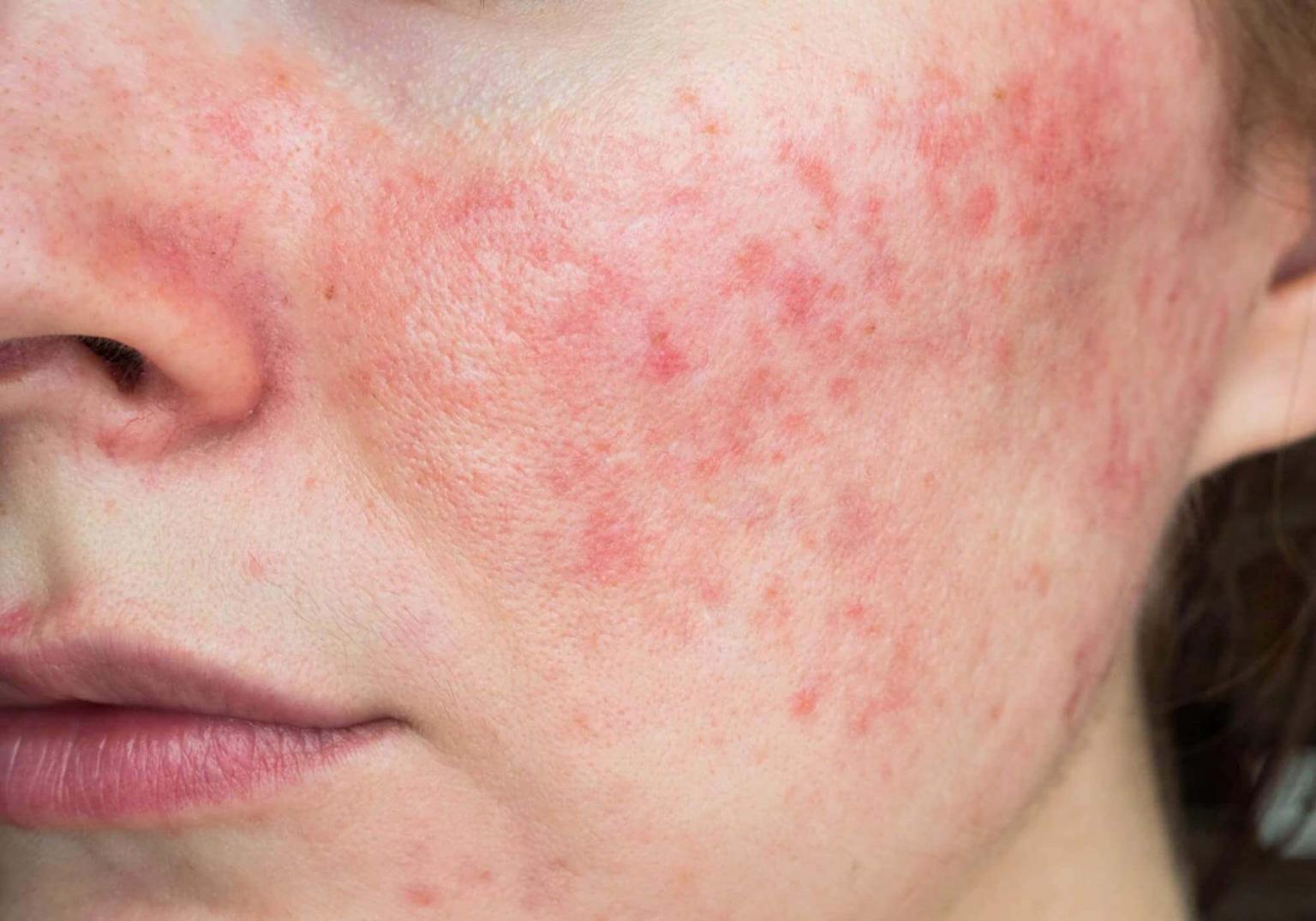 O que é rosácea? Conheça mais sobre a condição de pele!