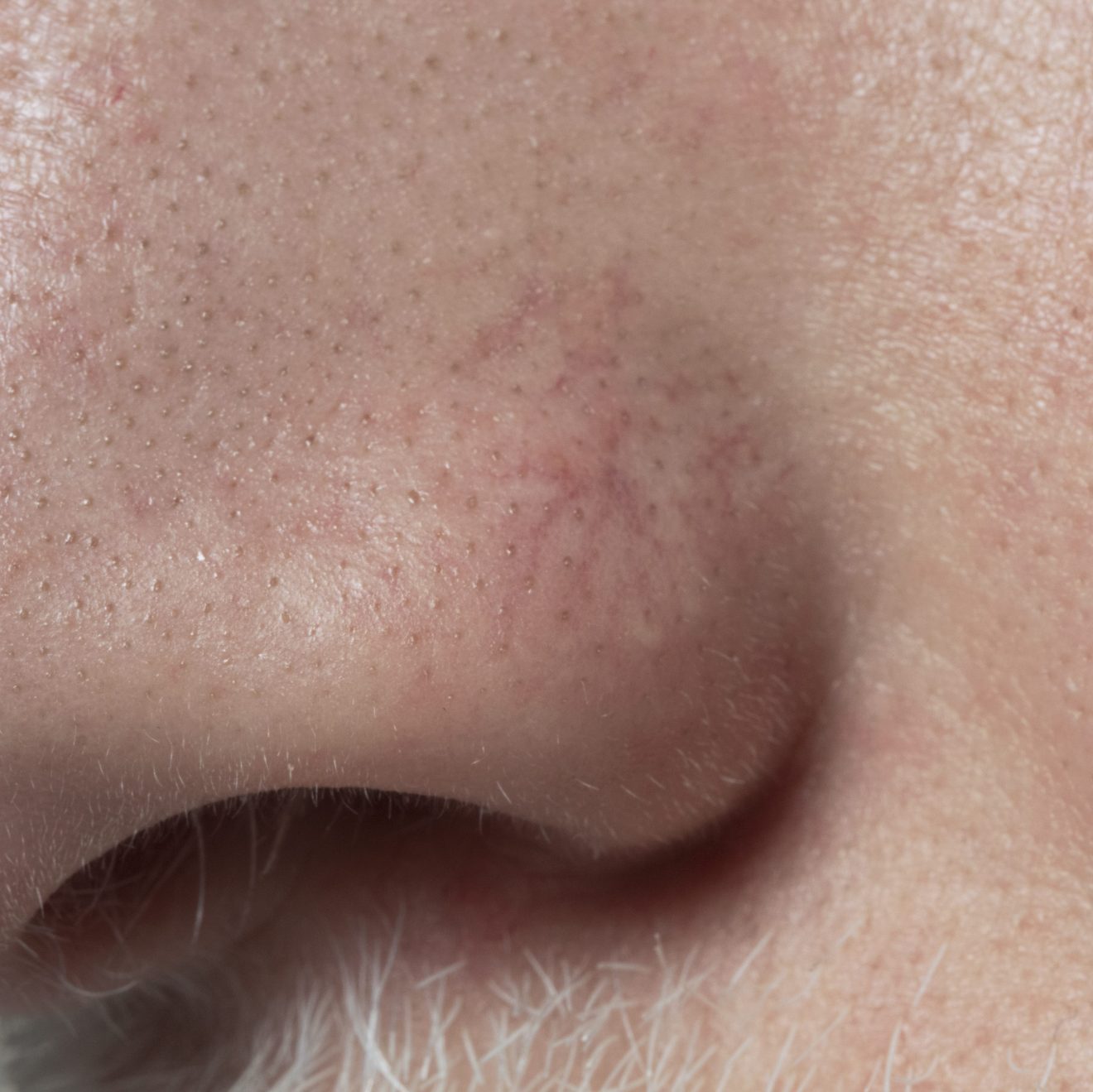 Cravos: O que são, como se formam e qual o tratamento? - Blog Dermage