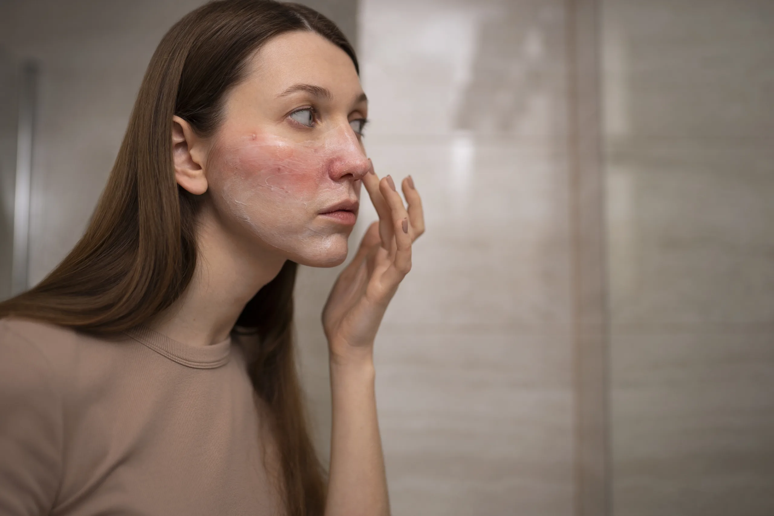 Acne Rosácea: Dicas para cuidados especiais com a pele - Blog Dermage